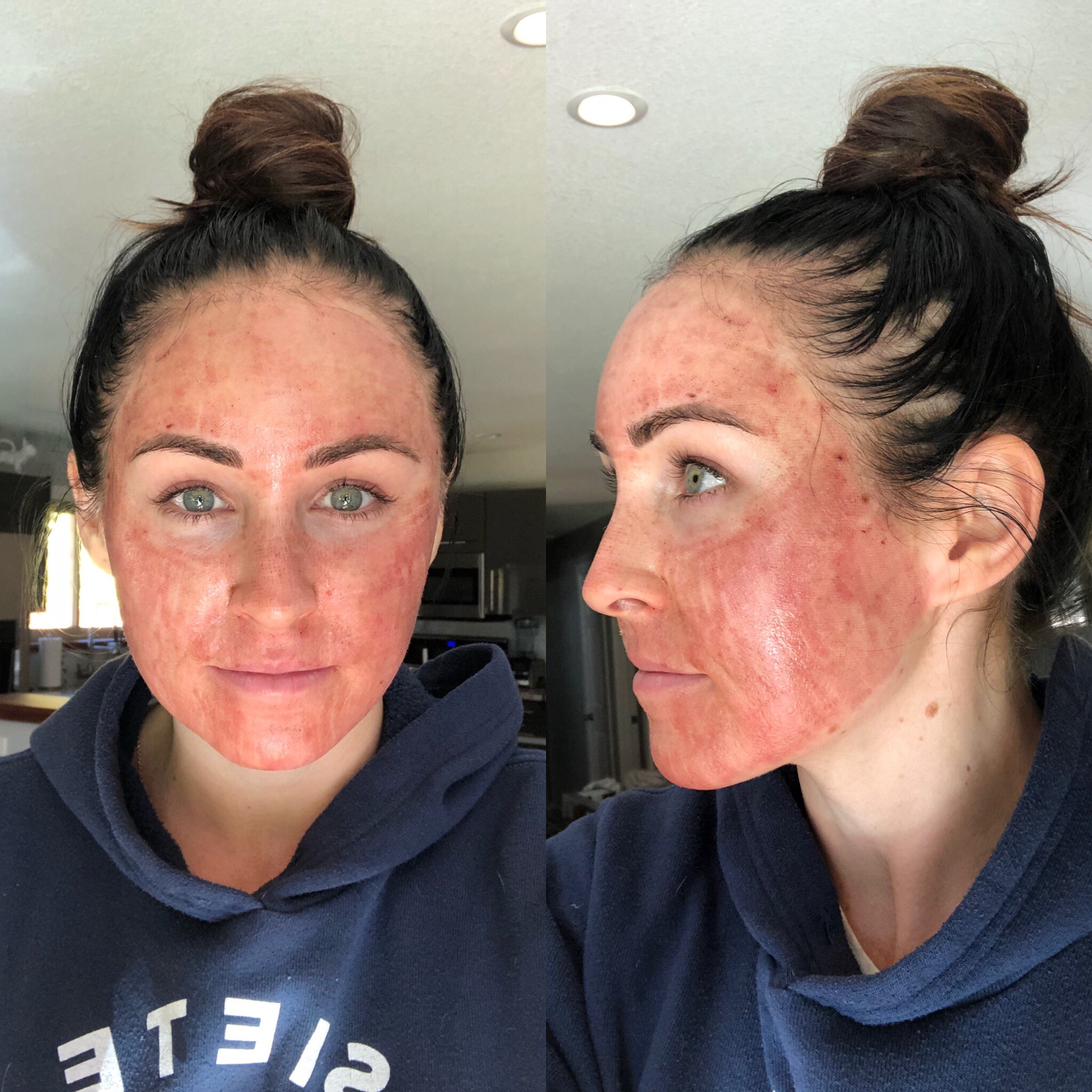 What To Expect From a Profractional Treatment (video!) - PaleOMG