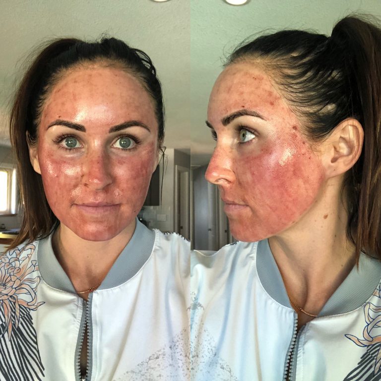 What To Expect From a Profractional Treatment (video!) - PaleOMG