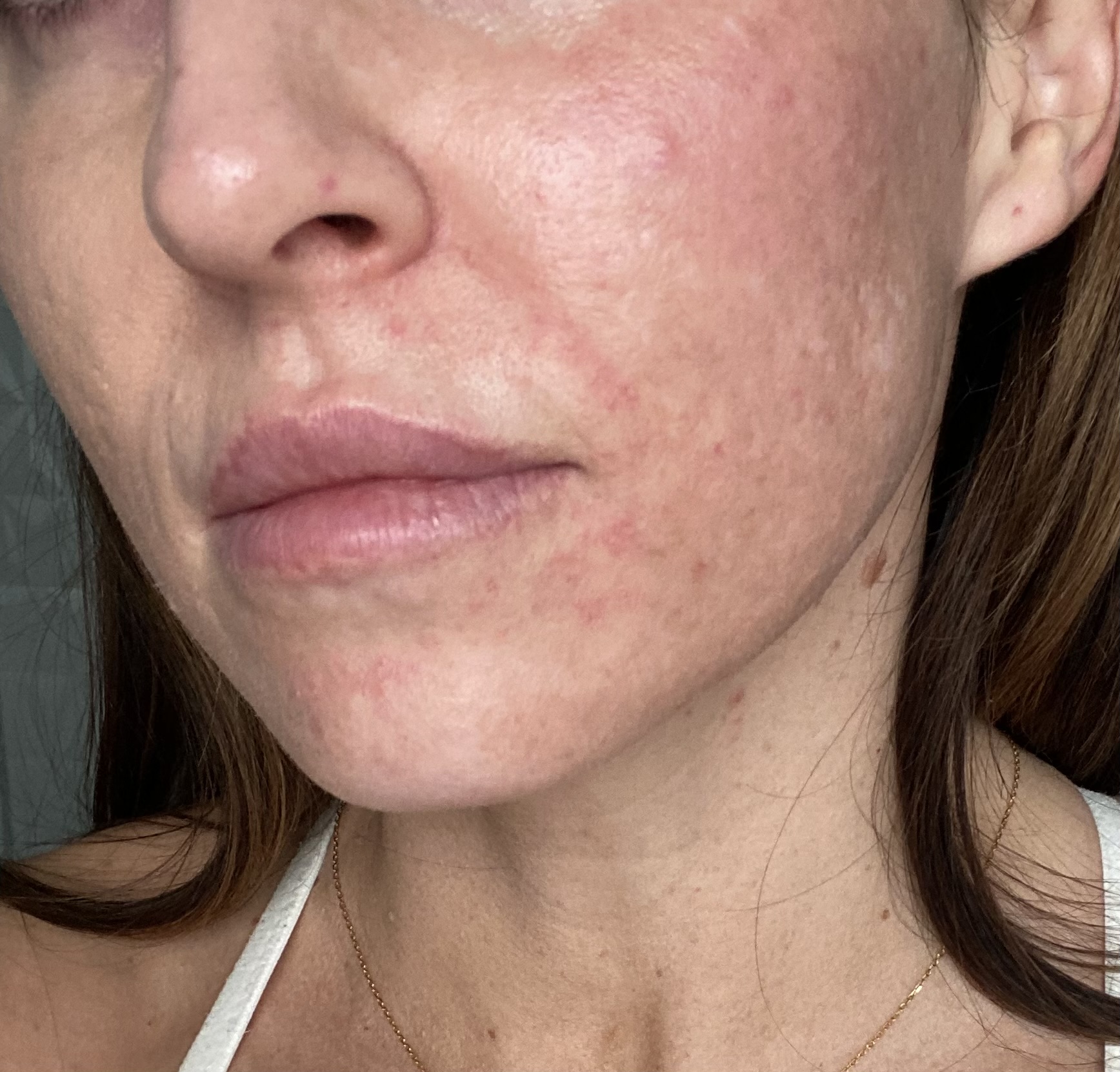 How To Treat Perioral Dermatitis Naturally - PaleOMG